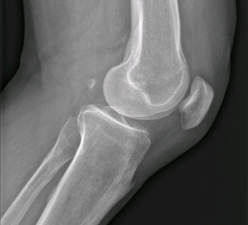 Calcificaciones - Laser Terapia Fisioterapia - FisioLáser